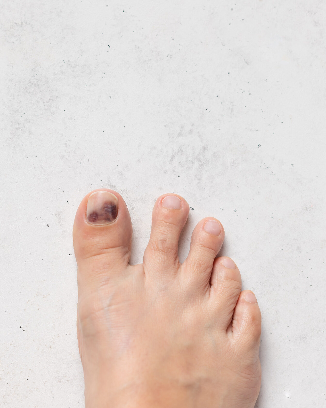 Diabetes-Füße: Kalt, Rot, Rissige etc. >> Was tun?